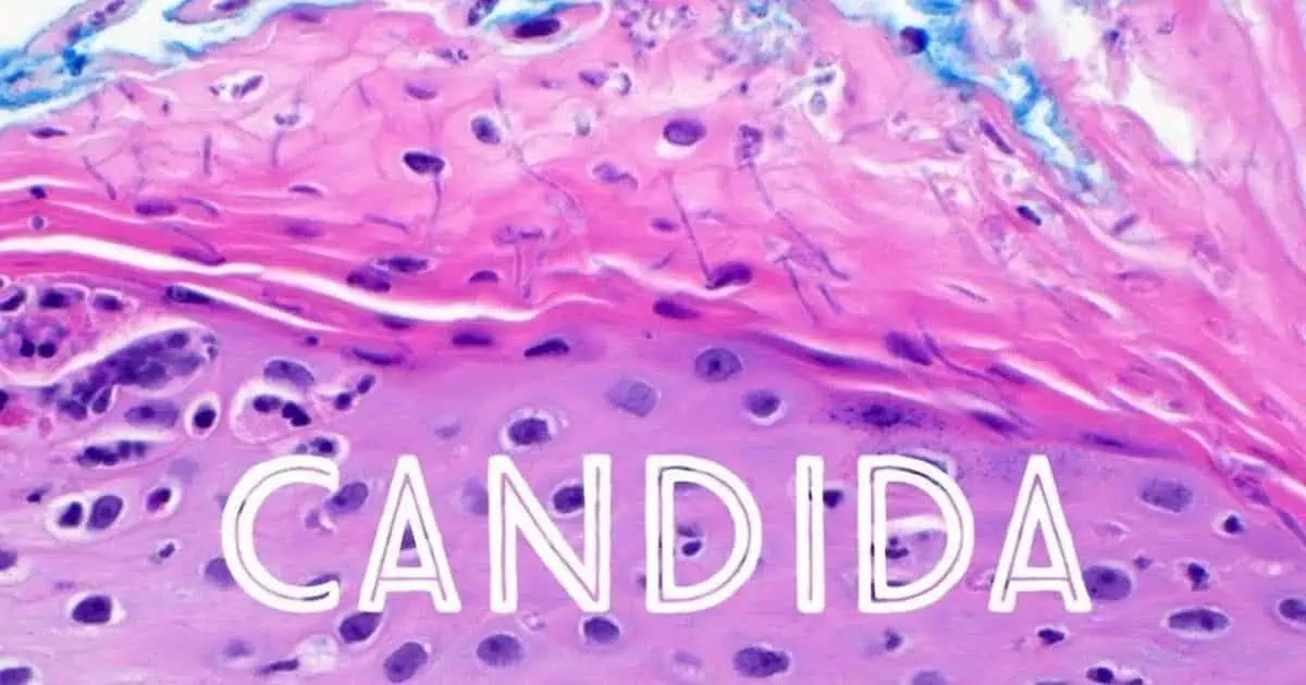 Candida Albicans Overgrowth: Causes, Symptoms, And Remedies